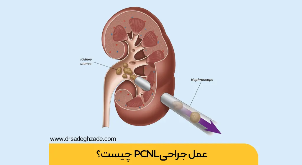 عمل PCNL چیست و چه کمکی به حذف سنگ کلیه می کند؟ - دکتر صادق زاده